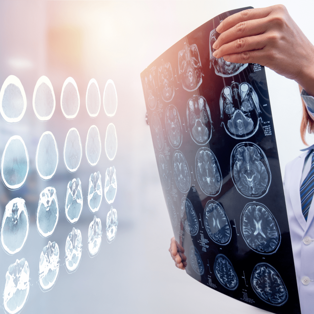 What Are the Long-Term Effects of a Brain Injury?